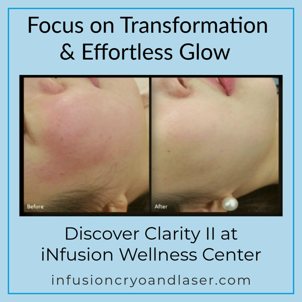 _INF 25 Clarity II Laser by Lutronic - Infusion Cryo and Laser